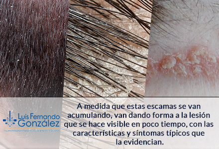 Seborrea Dermatitis Seborreica Del Cuero Cabelludo